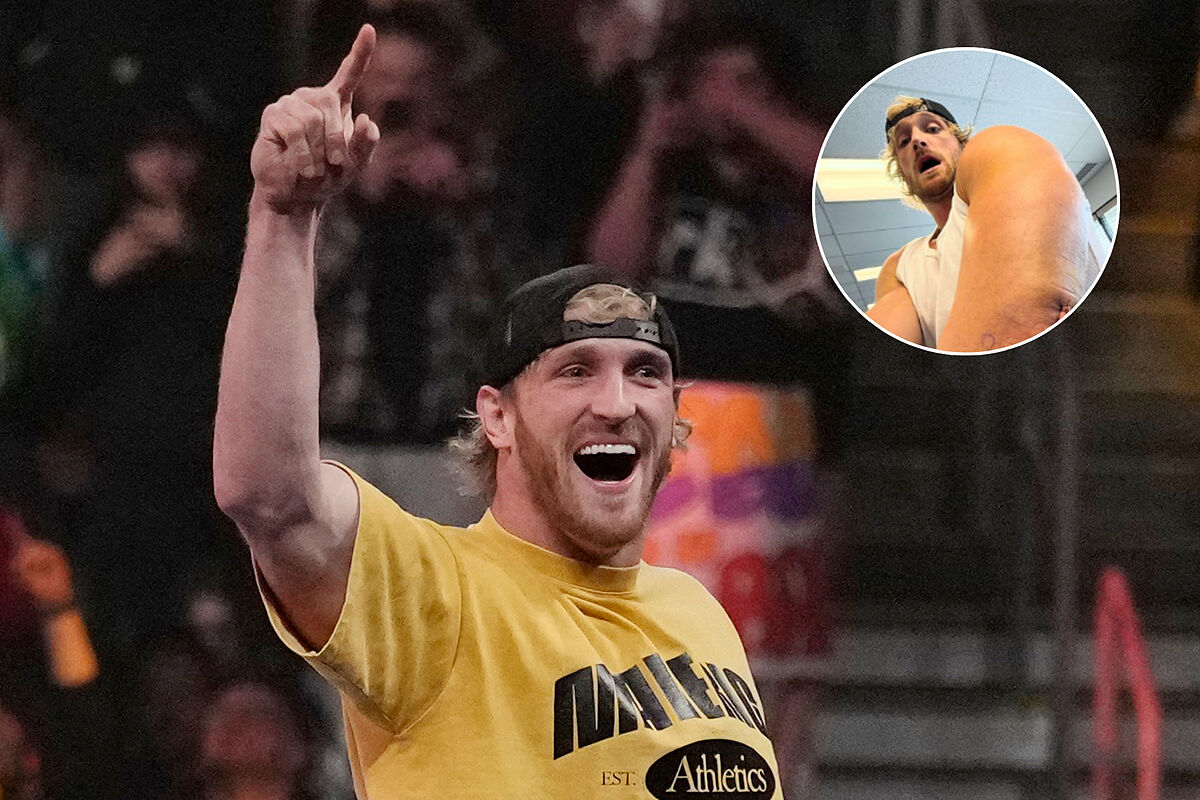 La espeluznante imagen de la lesión de Logan Paul tras ser operado ...